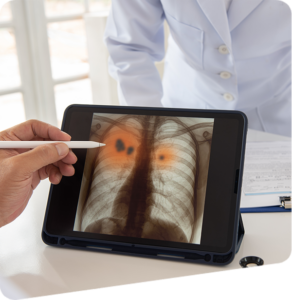 CT Lung Cancer Screening - South West Radiology